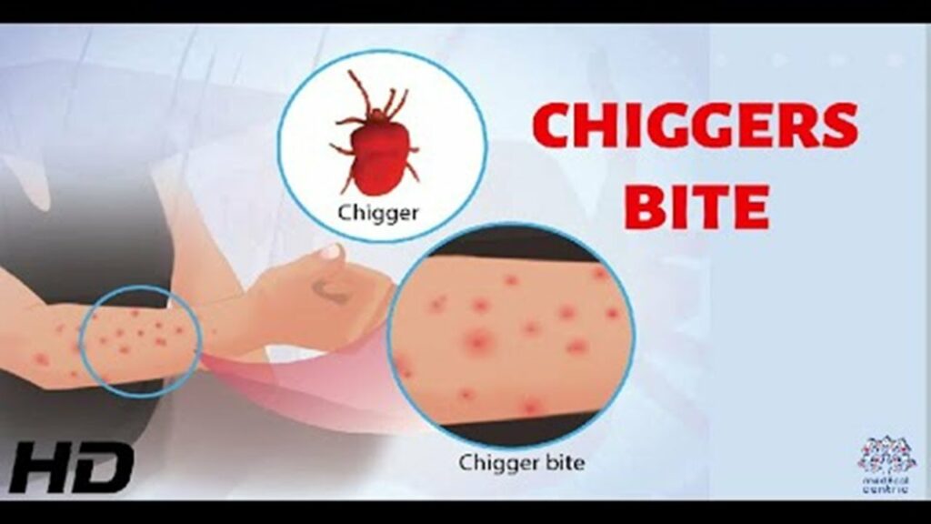Do chiggers exist in Rhode Island? - The Rhode Island Directory